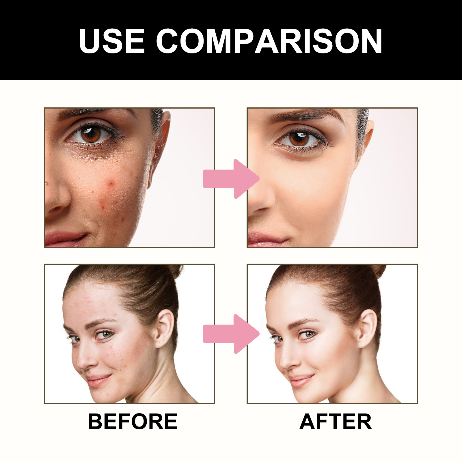 Acne Pimple Patch Waterproof Acne Cover Treatment Healing Pimple Remove ...