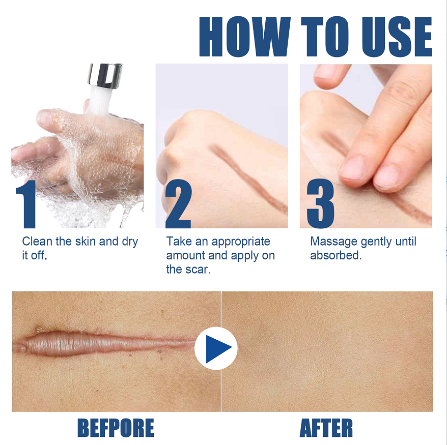 EELHOE Scar Cream 15g - Helps lighten Old & New Peklat, Pimple Marks ...