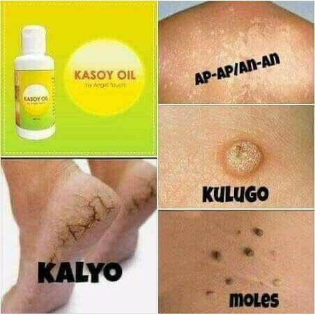 Kasoy Oil - Remove Warts - Filipino Favorite | Shopee Singapore