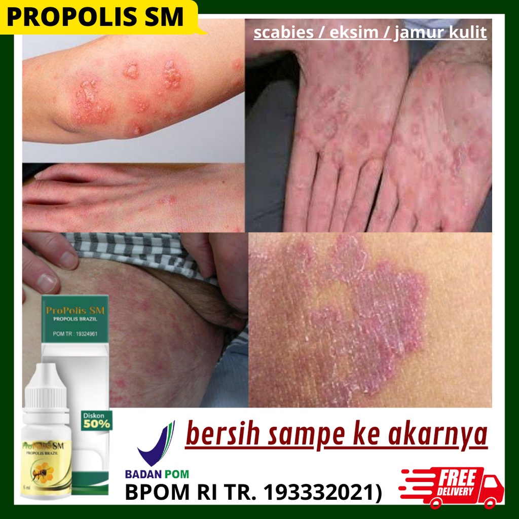 Scabies Medicine For Humans - Skin Fungus Thresher To The Roots ...