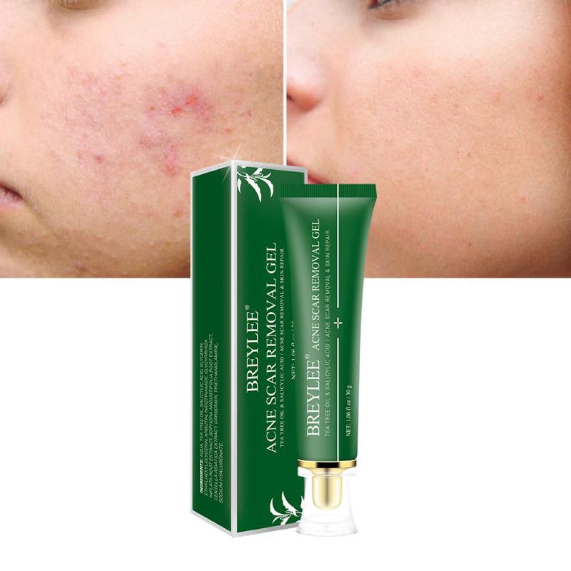 BREYLEE Acne Scar Remover Gel Tea Tree Essence Acne Treatment Fade Acne Marks 30g | Shopee Singapore