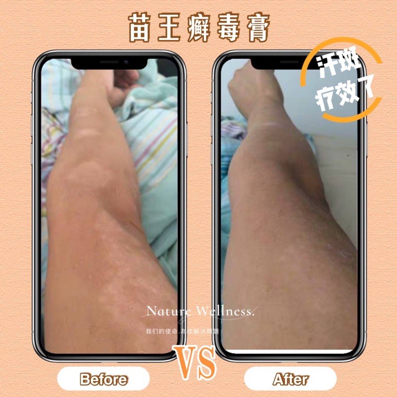 疗效汗斑 Effective on sweat spot ️ 苗王癣毒膏 Miao Wang Ringworm Cream 18g ...