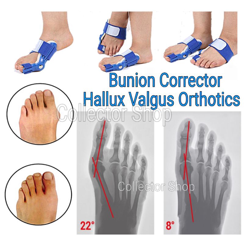 Bunion Corrector Jari kaki Pembetulan correct hallux valgus Orthotics ...