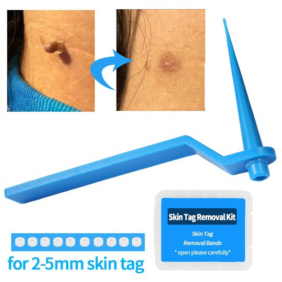 Skin Tag Remover, Safe and Painless Skin Tag Removal Kit for Face, Neck ...