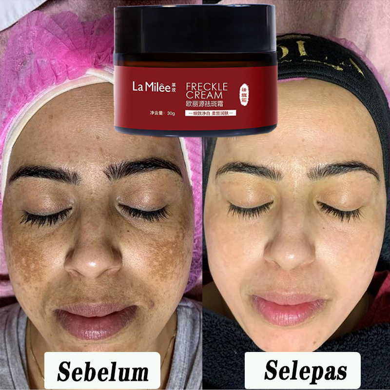 HITAM Remove Black Spots On The Face Powerful bpom Removes Spots On The ...