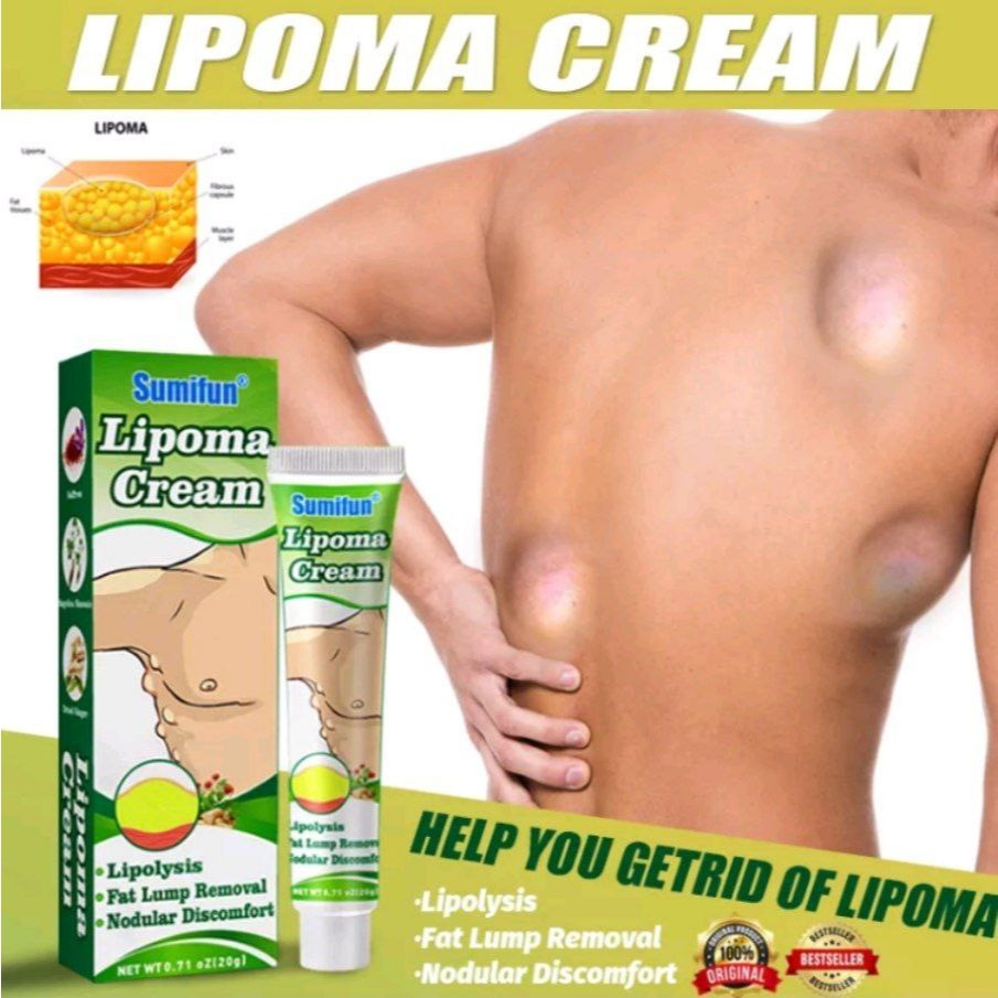 Treat lumps without surgery lipoma cream aft plz | Shopee Singapore