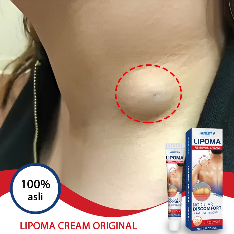 Lipoma cream original Medicine For Lumps lipoma Medicine 20g Medicine ...