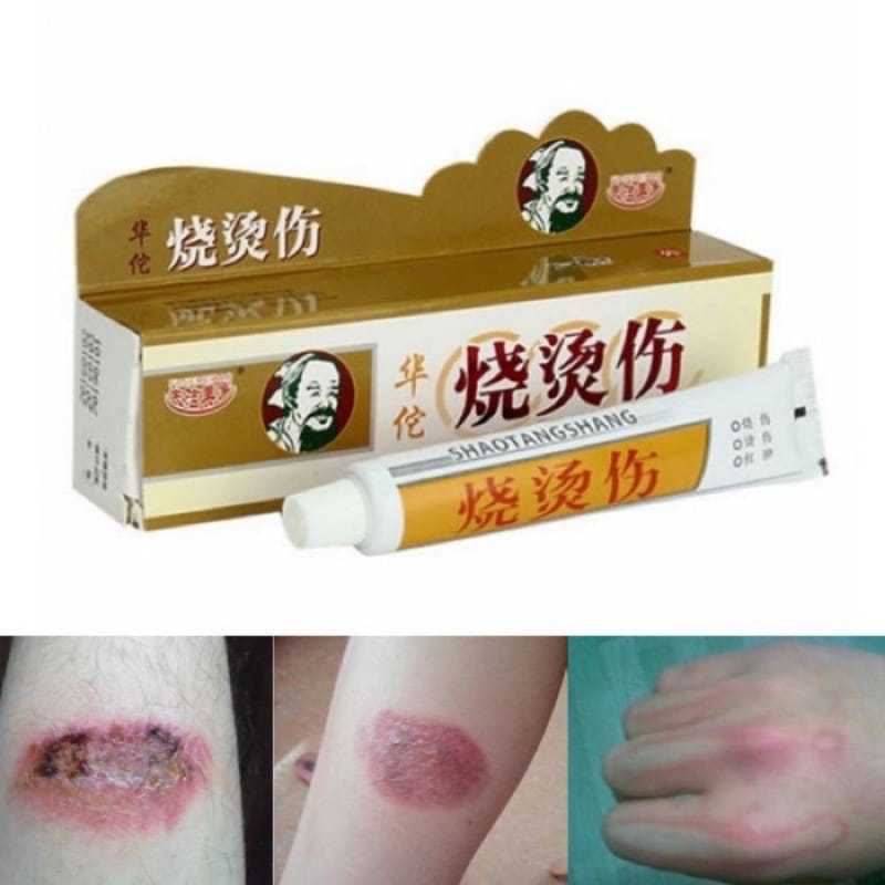 Burn Ointment Medicine for skin blisters on hot water, exhaust etc ...