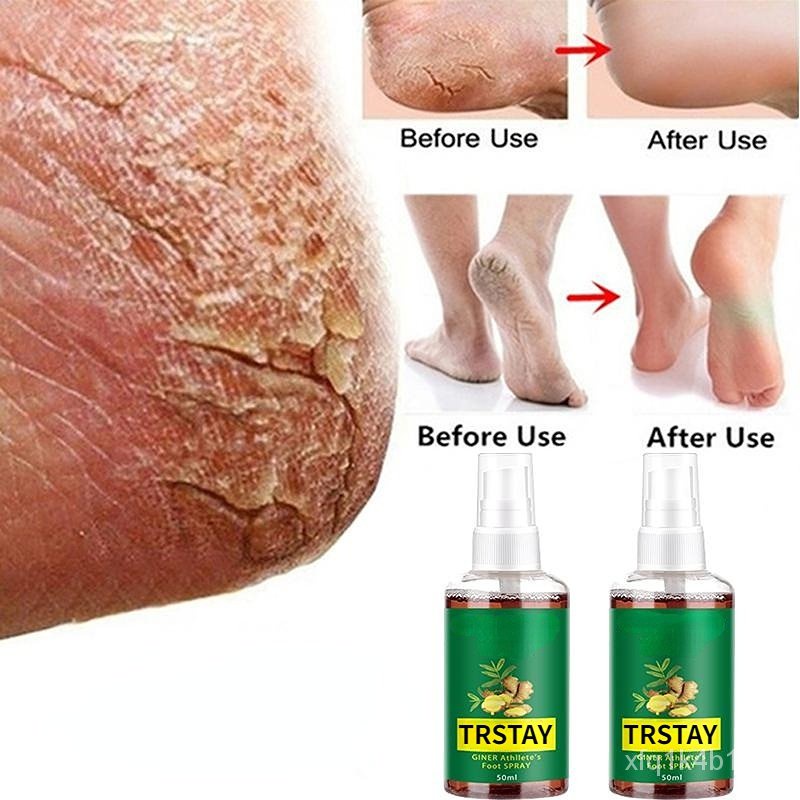 Bacterial and Fungal Inhibition Essential Oils Foot Cream Chapped Feet ...