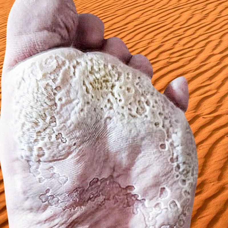 Honeycomb-three holes in the soles of the feet, foot pain, exce foot ...