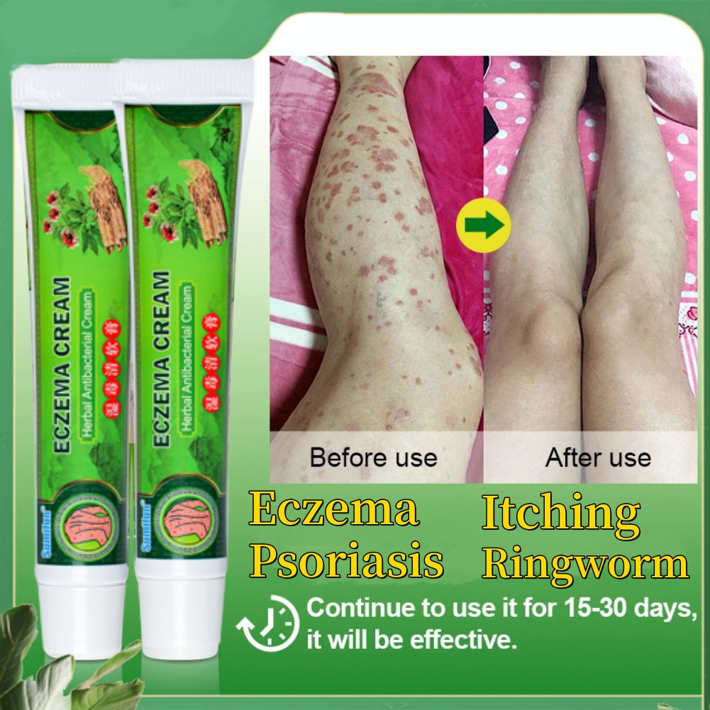 Eczema Treatment ubat gatal kulit Krim Psoriasis Antifungal Cream Itchy ...