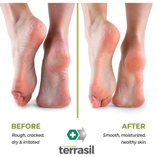 Terrasil Ointment Eczema & Psoriasis | Infection | Ringworm | Jock Itch ...