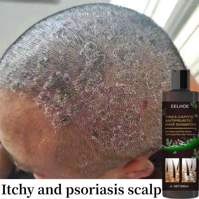 Syampoo Fatigue And Itching Head Psoriasis Scalp Itchy Scalp Antifungal Shampoo Scalp Treatment