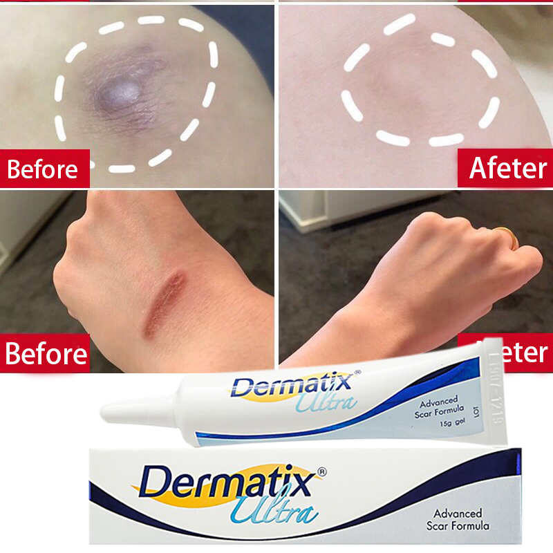 Dermatix Advanced Scar Formula Acne Scar Cream Keloid Scar Remover Krim ...