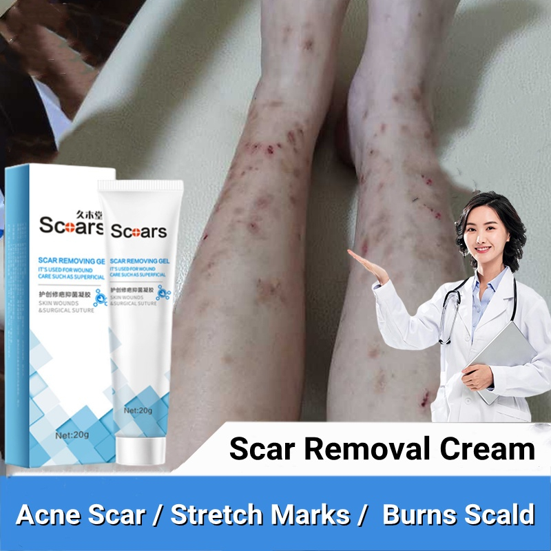 20g Scar Cream Cold Removing Gel Ointment Scars Skin Wound Pain Stretch ...
