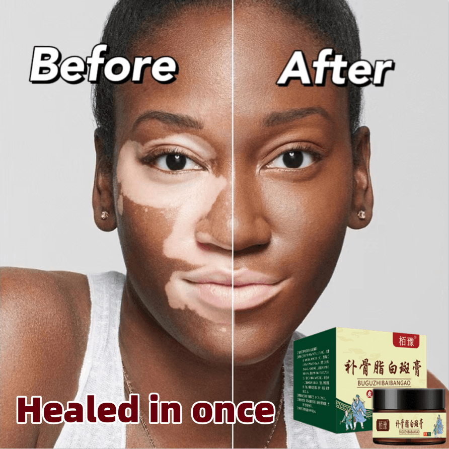 Vitiligo treatment cream Ubat Vitiligo White spots removal cream 20g ...