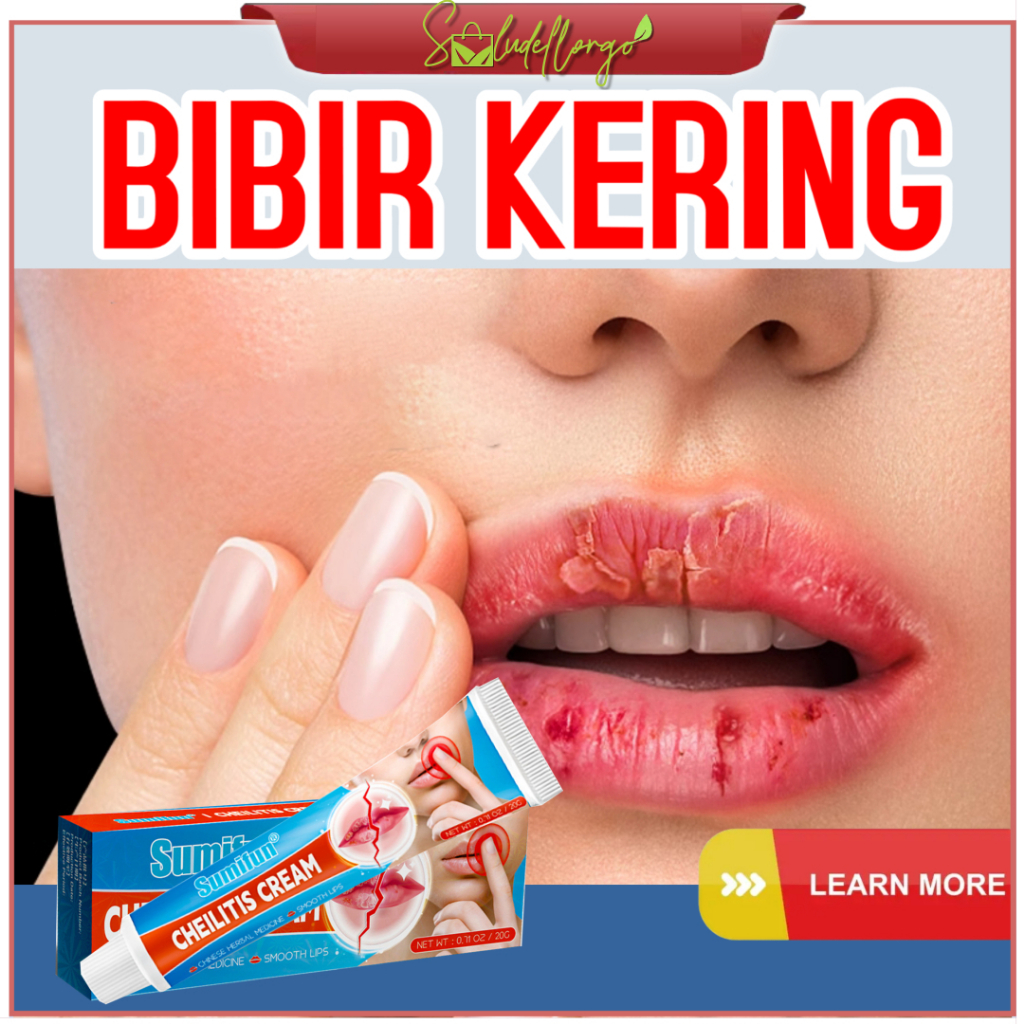 Chelitis Cream for Dry, Itchy, Scaly, Bleeding, Swelling, and Blisters ...