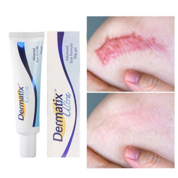 Dermatix ultra Scar Gel Dermatic Acne Scar Reduction Cream Advance Gel ...