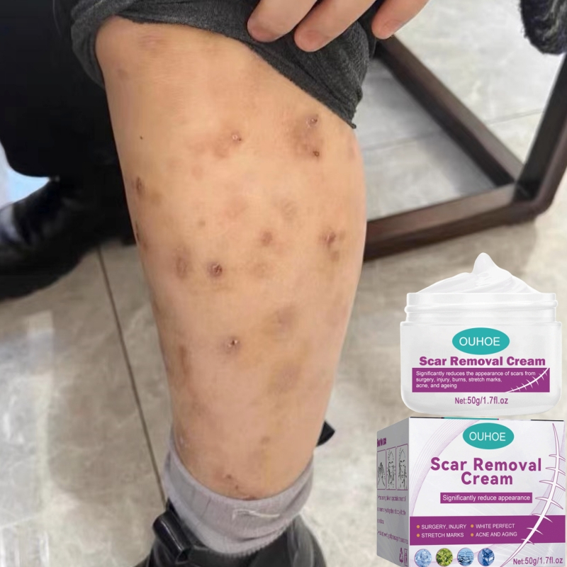 HITAM Black Grated Removing Cream Removes Old Scars Grated Foot ...