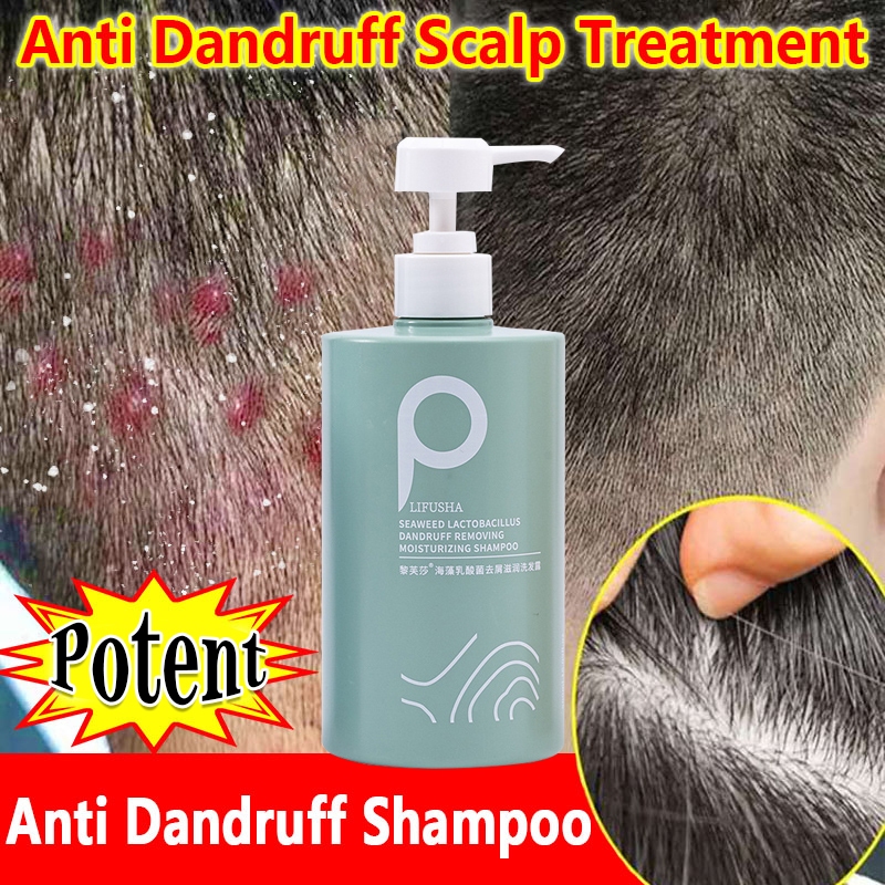 Syampoo kelemumur dan gatal kepala Psoriasis scalp Itchy scalp Anti ...