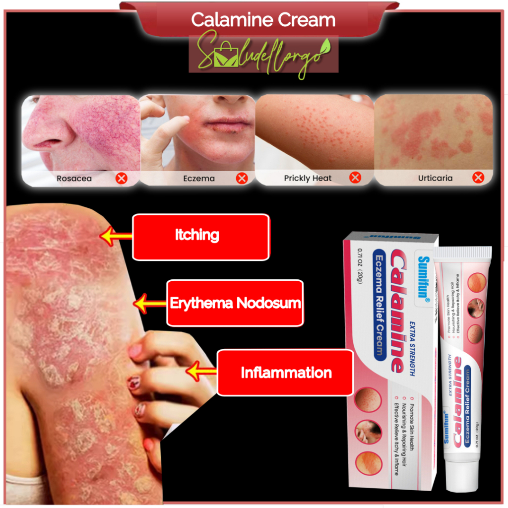 Anti Bacterial Eczema Calamine Cream Antifungal Skin Itching Red Rash ...