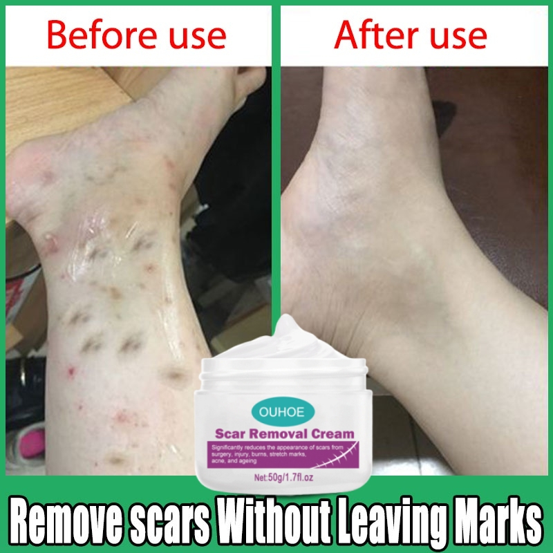 HITAM Cream Remove Dark Scars Remove old scars Foot scar medicine ...