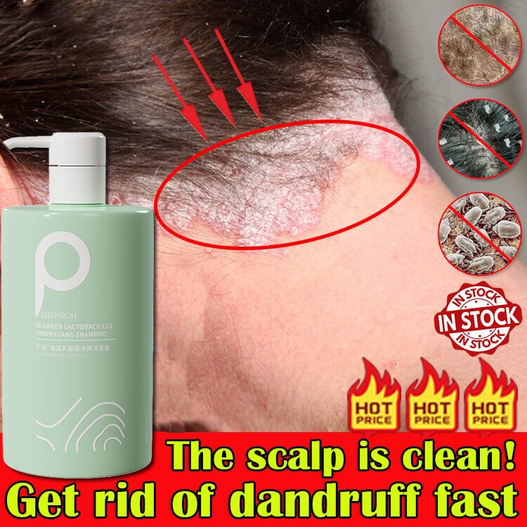 Shampoo Hair Shampoo Psoriasis Shampoo Kelemtua Scalp Anddruff Head