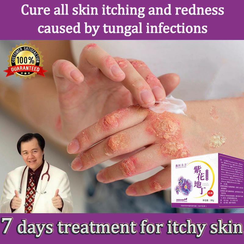 krim ekzema ubat gatal kulit menghilangkan eritema Salap Psoriasis ...