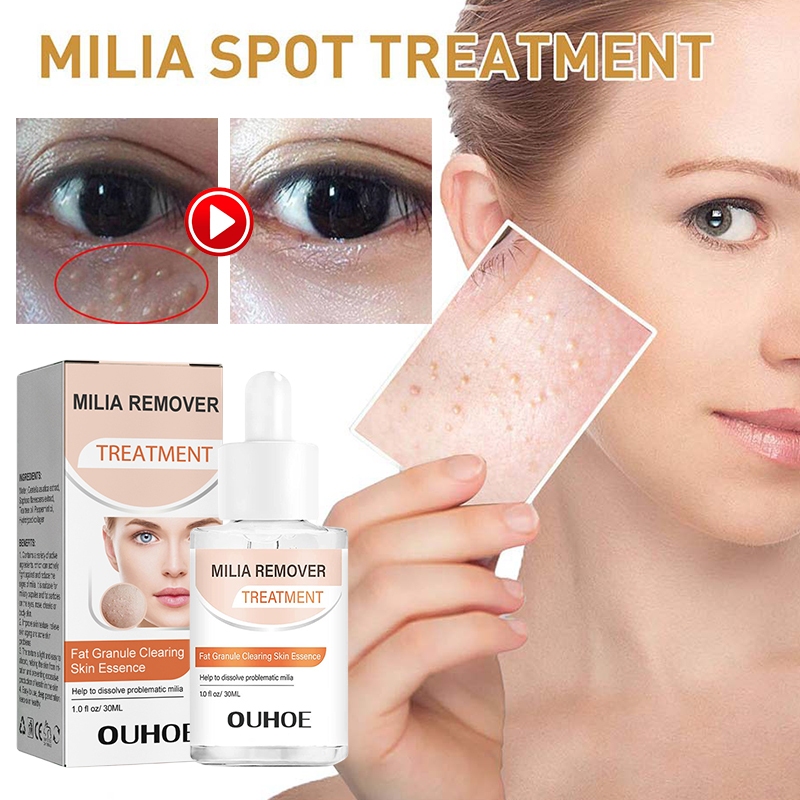 milia remover treatment milia seed remover ubat milia syringoma removal ...