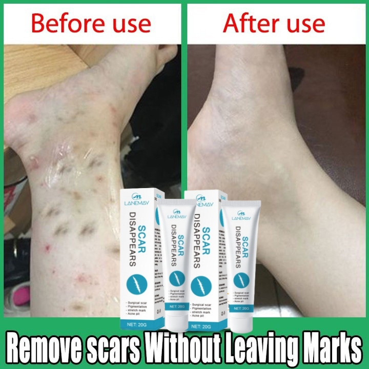 Scar removal cream cream removes black scars Removes scabies removes ...