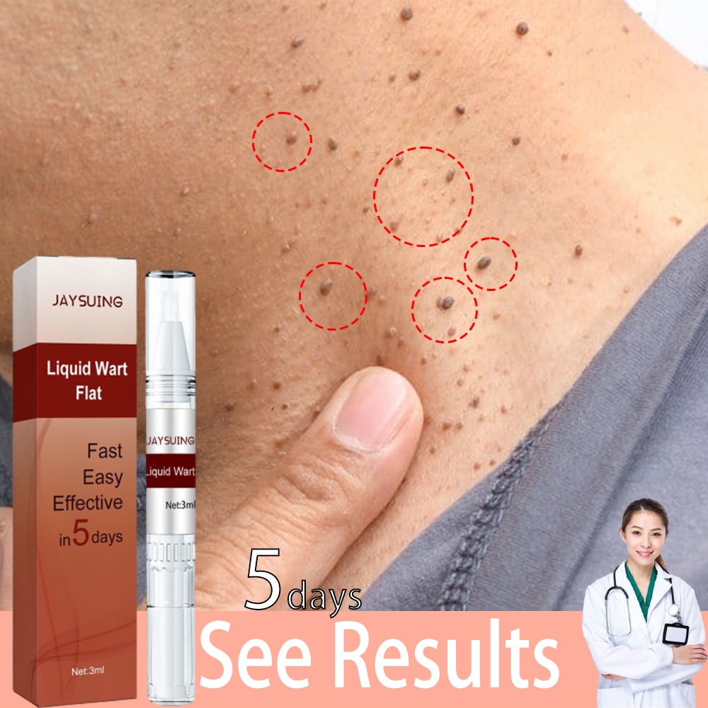 Warts and Mole Remover Pen Skin Tags Warts and Moles Treatment Liquid ...