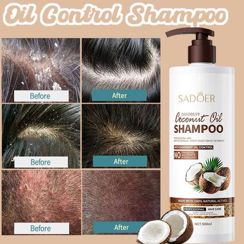 Sadoer ANTI dandruff shampoo dandruff remover dandruff treatment ...