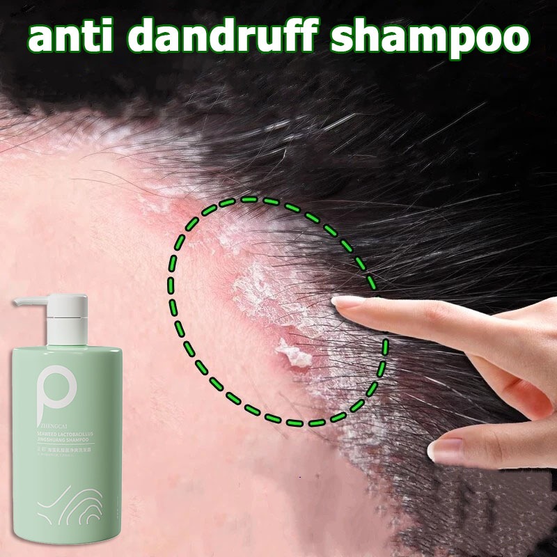 Dandruff shampoo psoriasis shampoo hair shampoo head medicine scalp ...