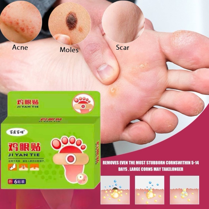 CORN STICKERS JI YAN TIE Plaster wart removal mole black spots skin tag ...