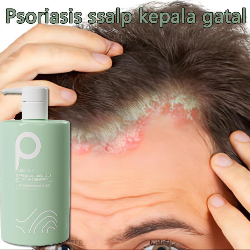 Shampoo Kelemtua Shampoo Psoriasis Shampoo Hair Shampoo Scalp Dandruff