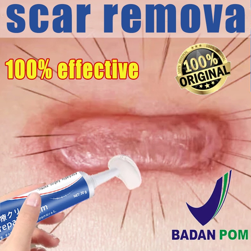 Keloid scar remover hilangkan parut gel scar reducer Smooth Skin ...