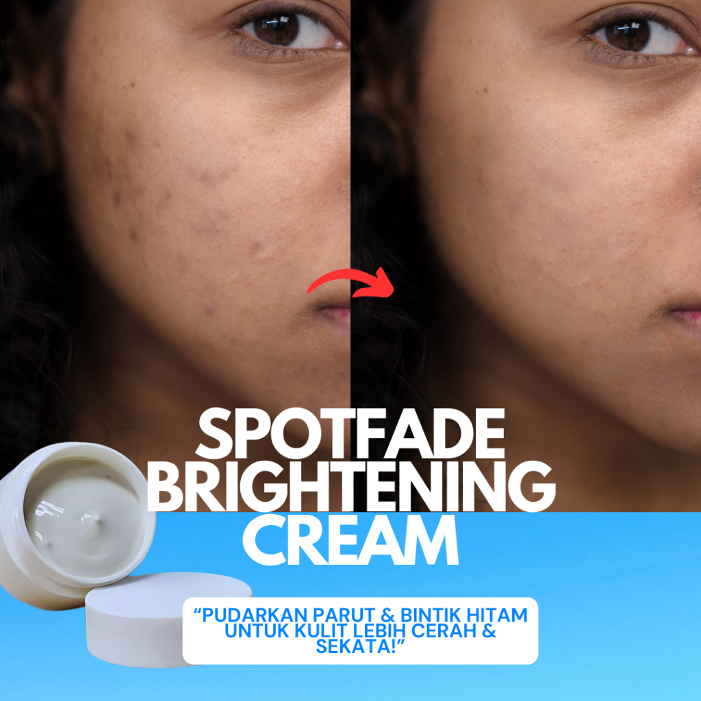 HITAM Spotfade Brightening Cream, Cream to Remove Dark Spots & Acne ...