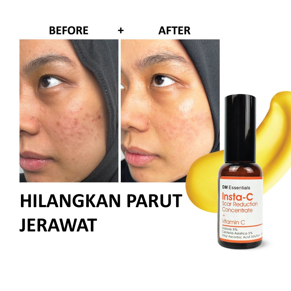 Insta-C Scar Reduction Vitamin C Scar Removal Cream Repair Old Scars ...