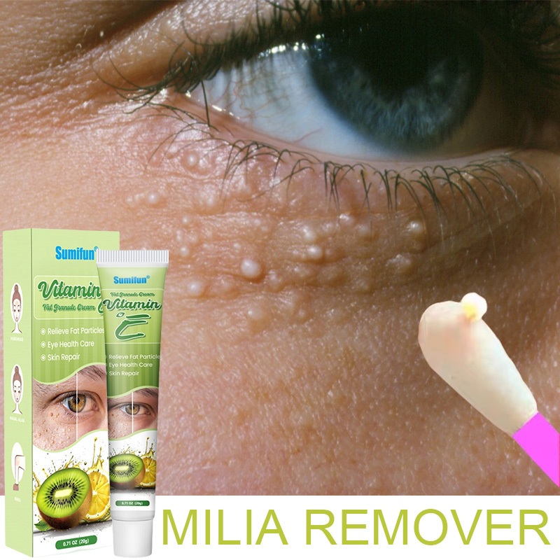 krim milia seed remover vitamin E eye milia cream fat granule syringoma ...