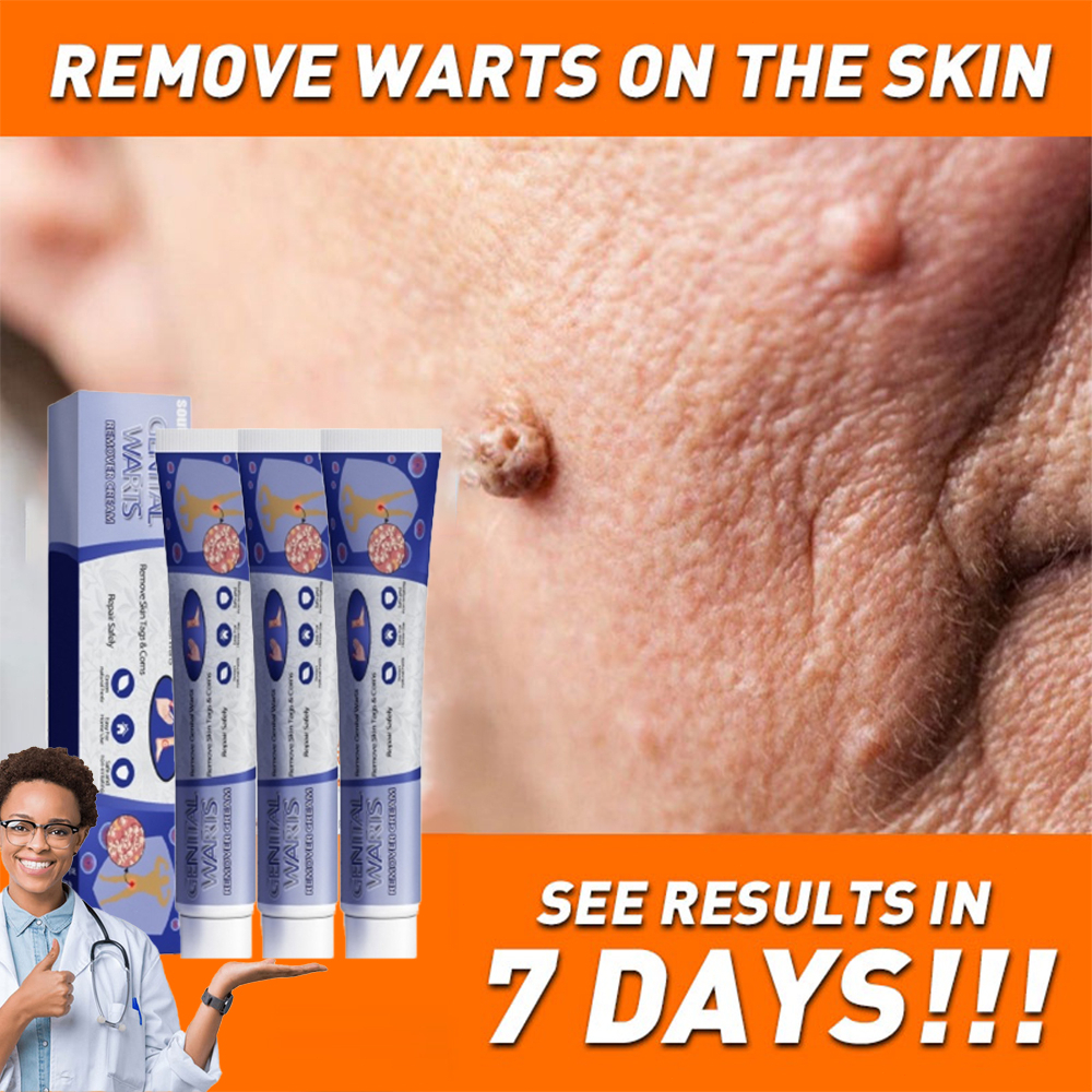 Ubat buang kutil ketuat tahi lalat biji kolestrol Mole Removal Wart ...