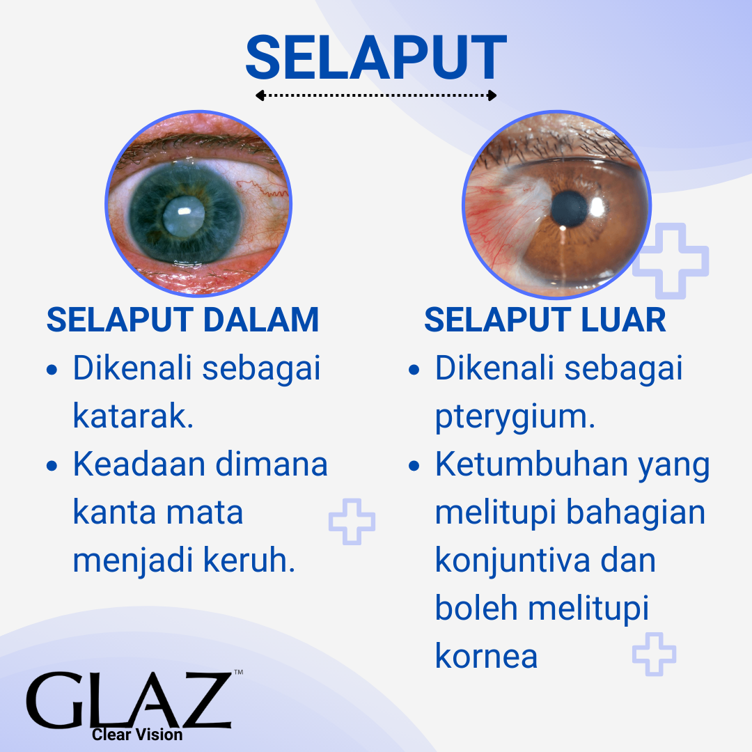MATA Glaz EYE DROP EYE REMOVAL Cataracts Nearsightedness Pain Itching ...