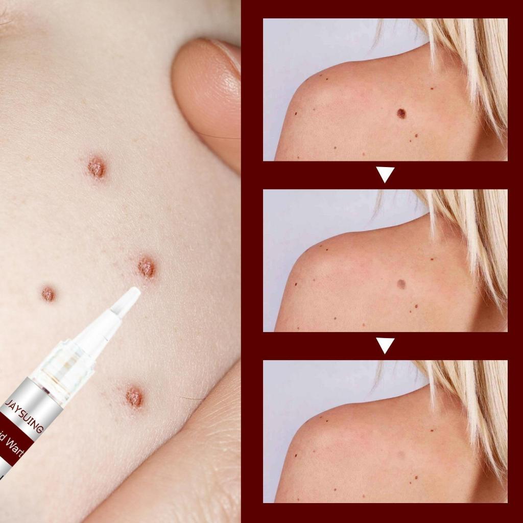 Ubat ketuat Tahi lalat remover Skin tag remover Buang tahi lalat dan ...