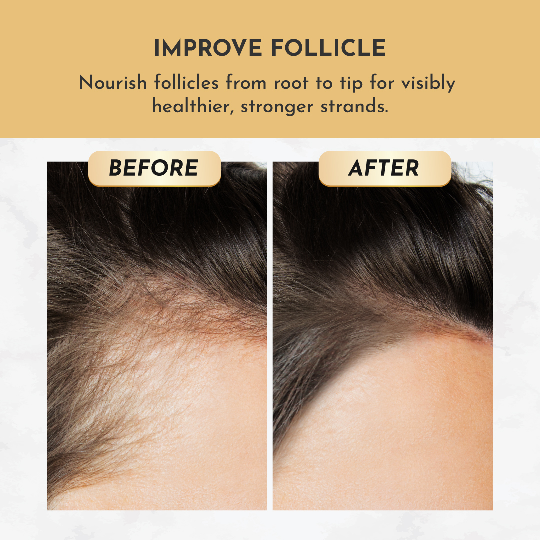 SURI Hair Fall Treatment Set Shampoo Conditioner Serum Anti Hair Loss ...