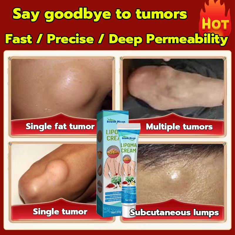 Lipoma Removal Cream lipoma cream Lipoma Removal Ointment Anti Tumor ...