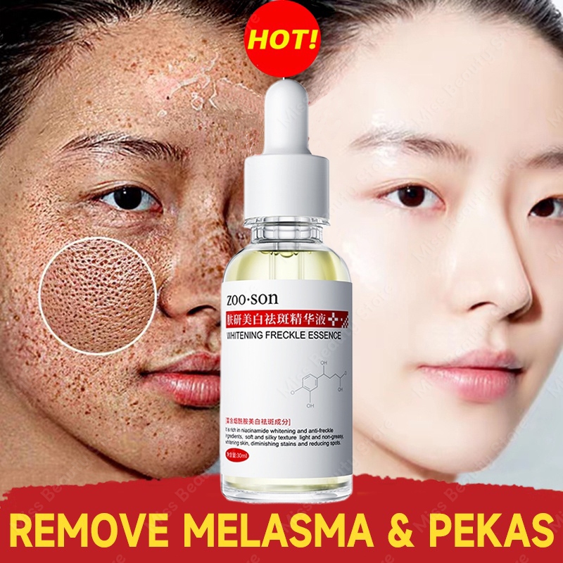 30ml Pekas Remover Serum For Melasma And Dark spot Melasma Serum Pekas ...