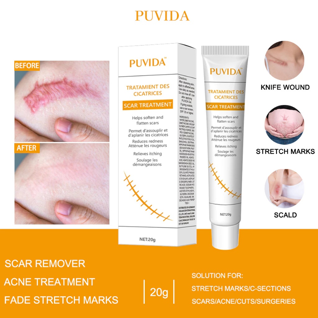 Scar Remover For Old Remover Cream/Old Scar On Leg Remove Acne Scar ...
