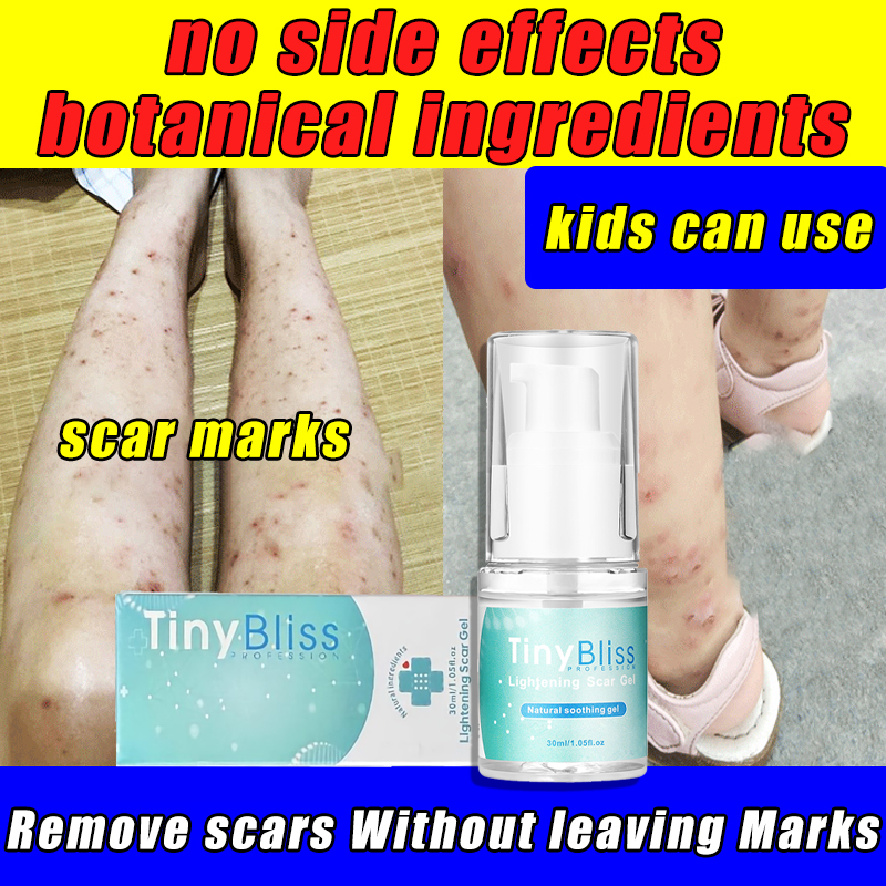Tiny Bliss Scar Removal Cream For Kid Effectively Lightens Scar Marks ...