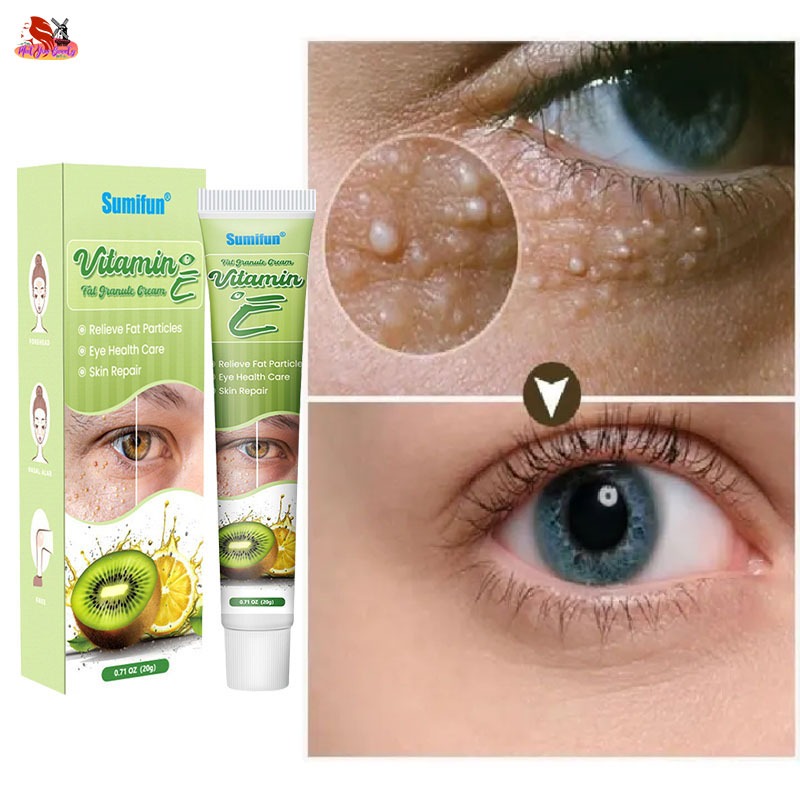 Milia Removal Cream Vitamin E Fat Granules Remover Eye Cream Effective ...