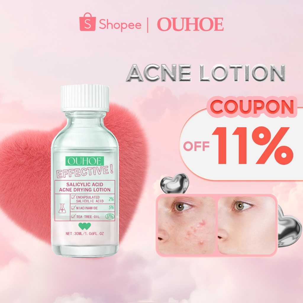 OUHOE Salicylic Acid Acne Drying Lotion 30ml Pimple Warrior Salicylic ...