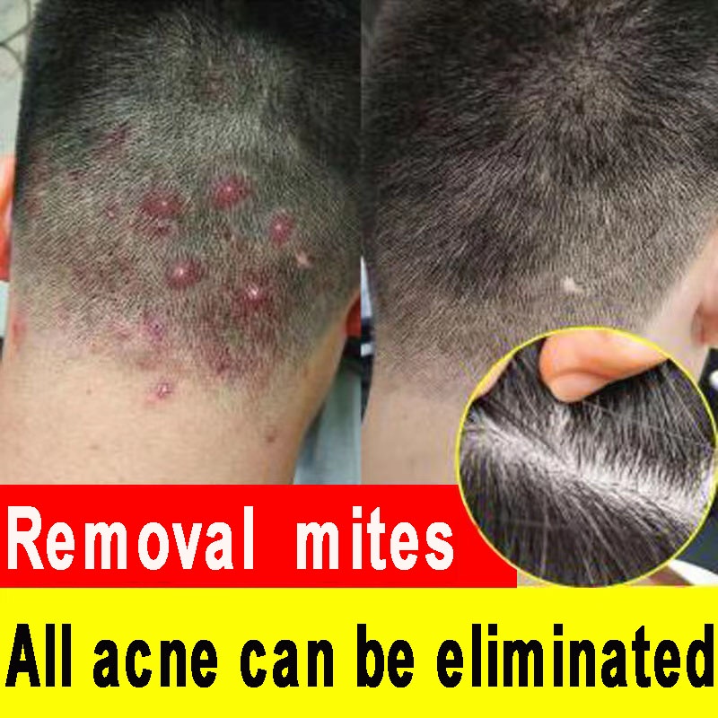 Acne Cream Pimples Cream Skin care Acne Removing Cleansing Cream ...